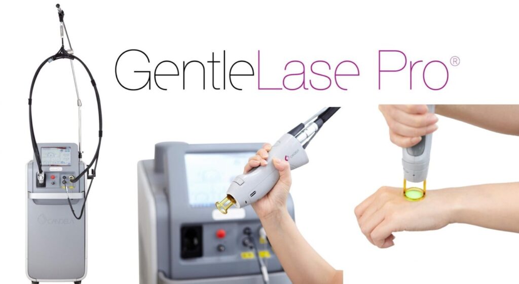 ジェントルレーズ プロ(GentleLase Pro) 熱破壊式脱毛機 | 医療脱毛の口コミ徹底比較 2024年版